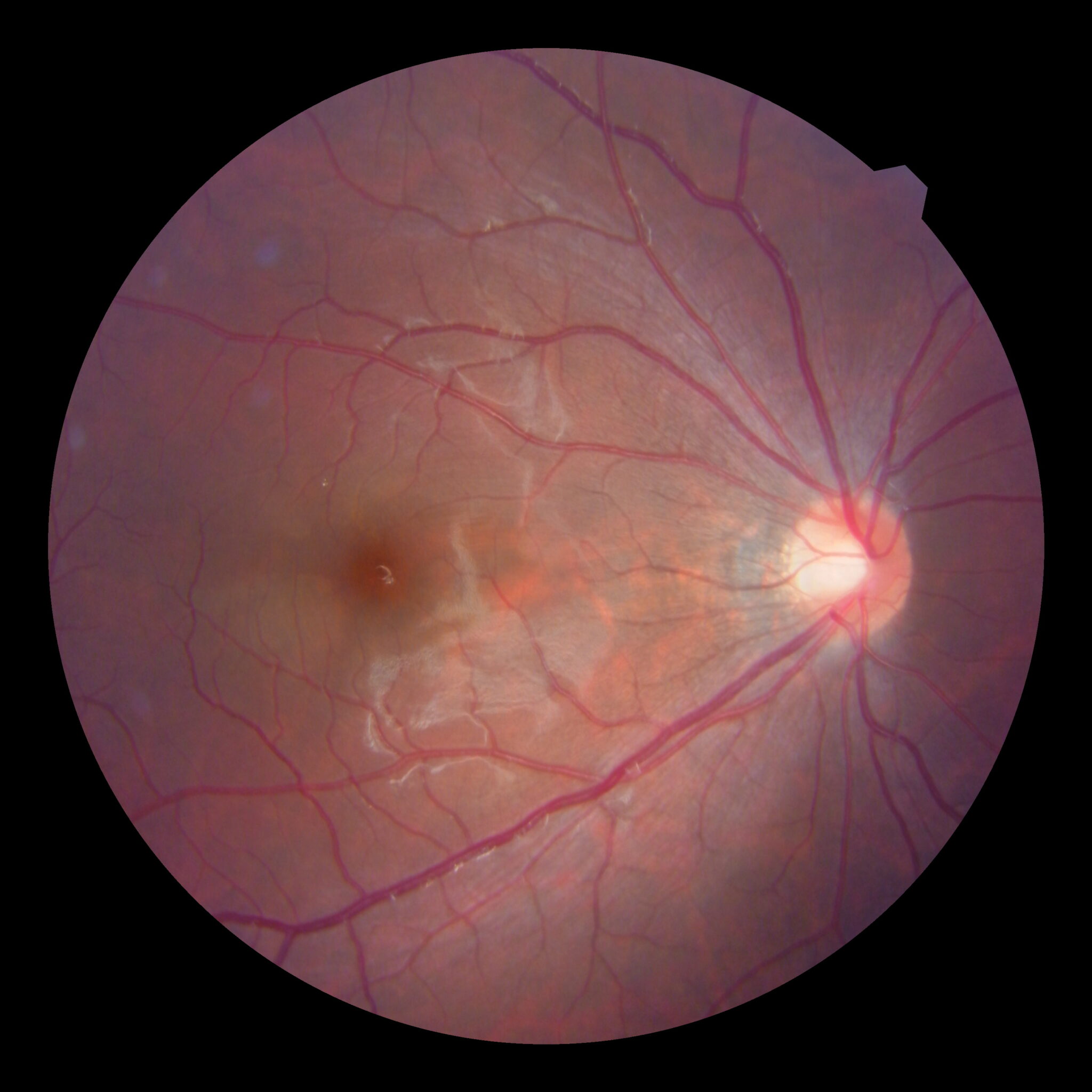 Acute Macular Neuroretinopathy (AMN)｜荻窪駅前眼科｜白内障手術、網膜硝子体手術、緑内障手術
